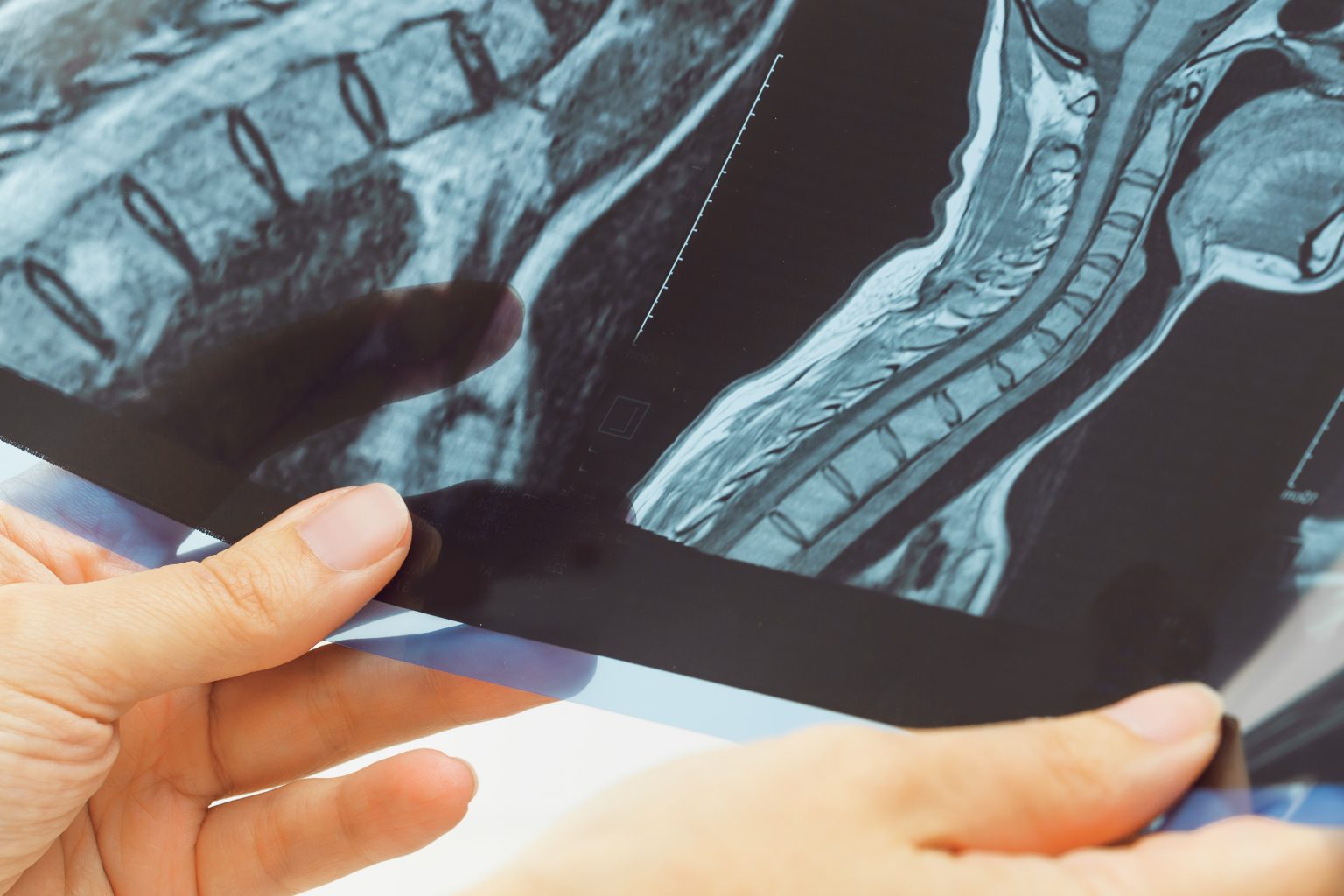 Seeking Compensation for a Durotomy After a Spinal Surgery - Berkowitz ...